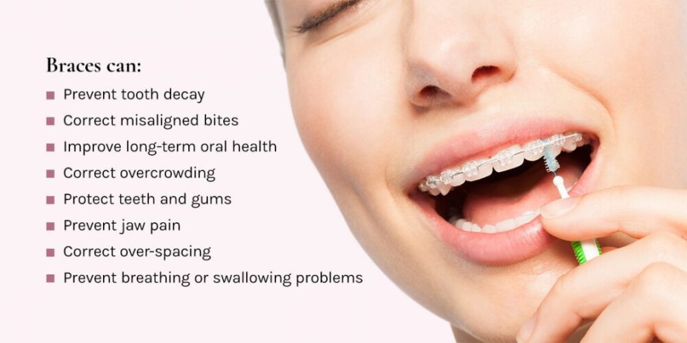 How to Know If You Need Braces | Black Orthodontics How to Know If You Need Braces | Black Orthodontics